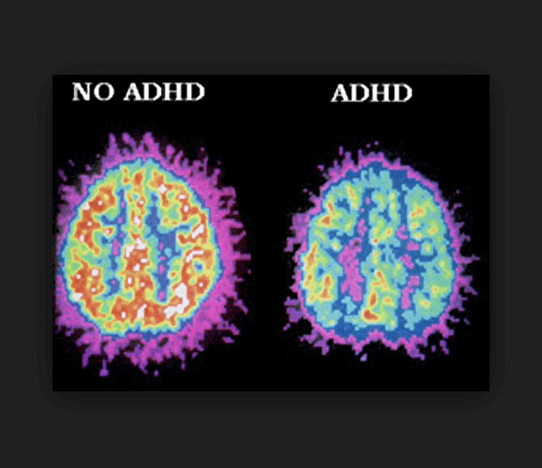 The First Pillar of ADHD: An Interest-Based Nervous System – The ADHD ...